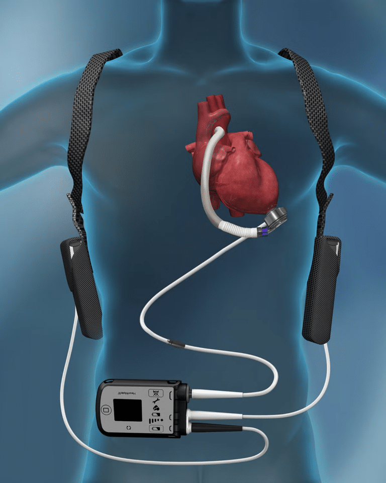 LVAD - Lovelace Health System